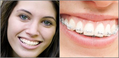 Types of Dental Braces | Coast Dental